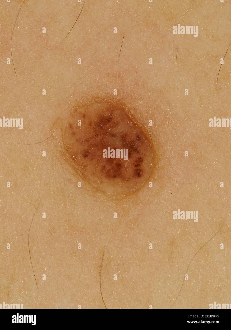 Dermatoscope image of an intradermal naevus. This is a benign skin ...