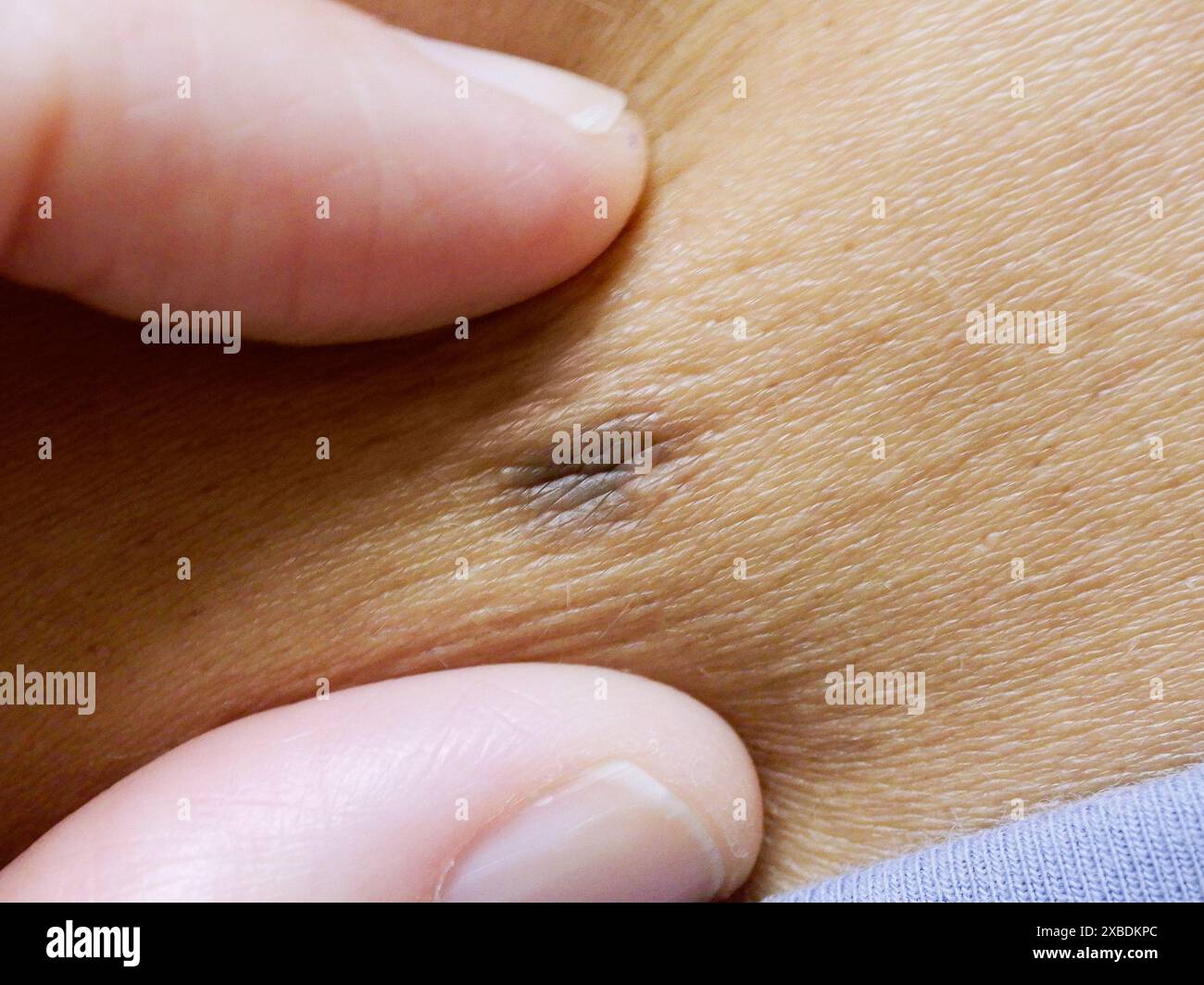 Doctor performing a pinch test on a dermatofibroma on the abdomen of a ...