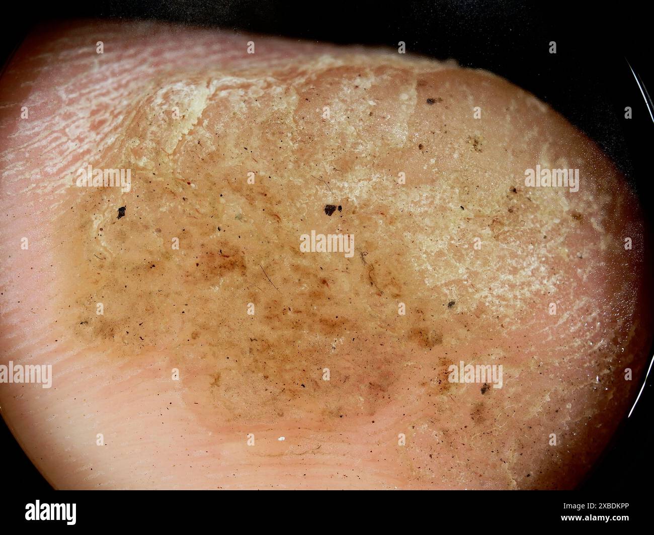 Dermatoscope image of verrucas on a patient's toe. Verrucas, also known ...