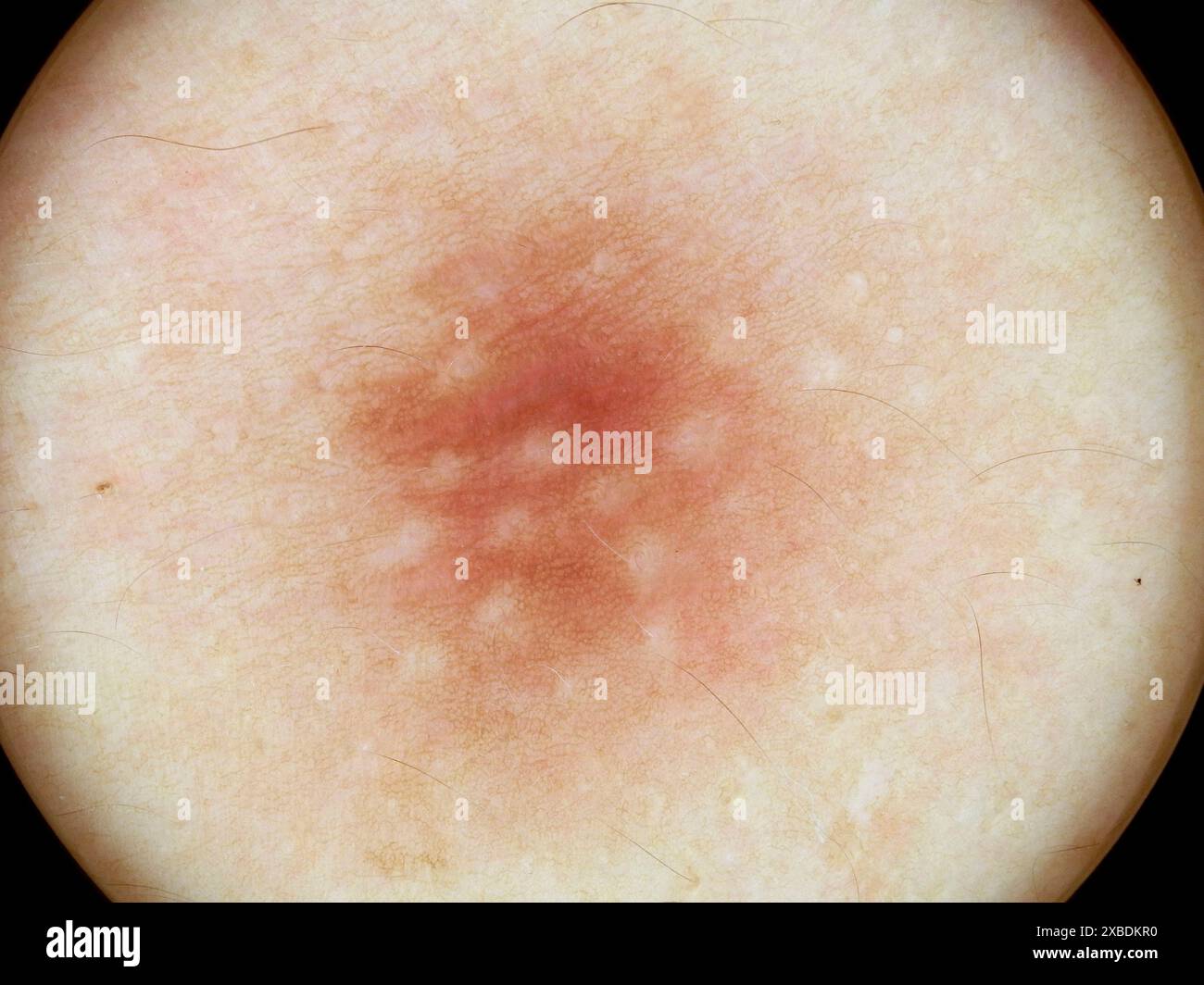 Dermatoscope image of a dermatofibroma on the skin of a 40 year old ...