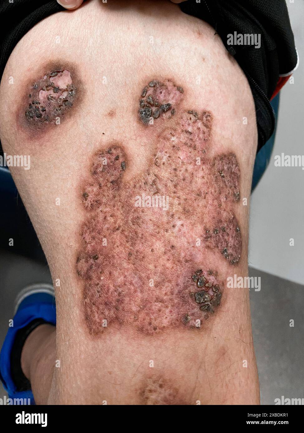 Healing pyoderma gangrenosum lesions on the leg of a patient who is being treated with ...