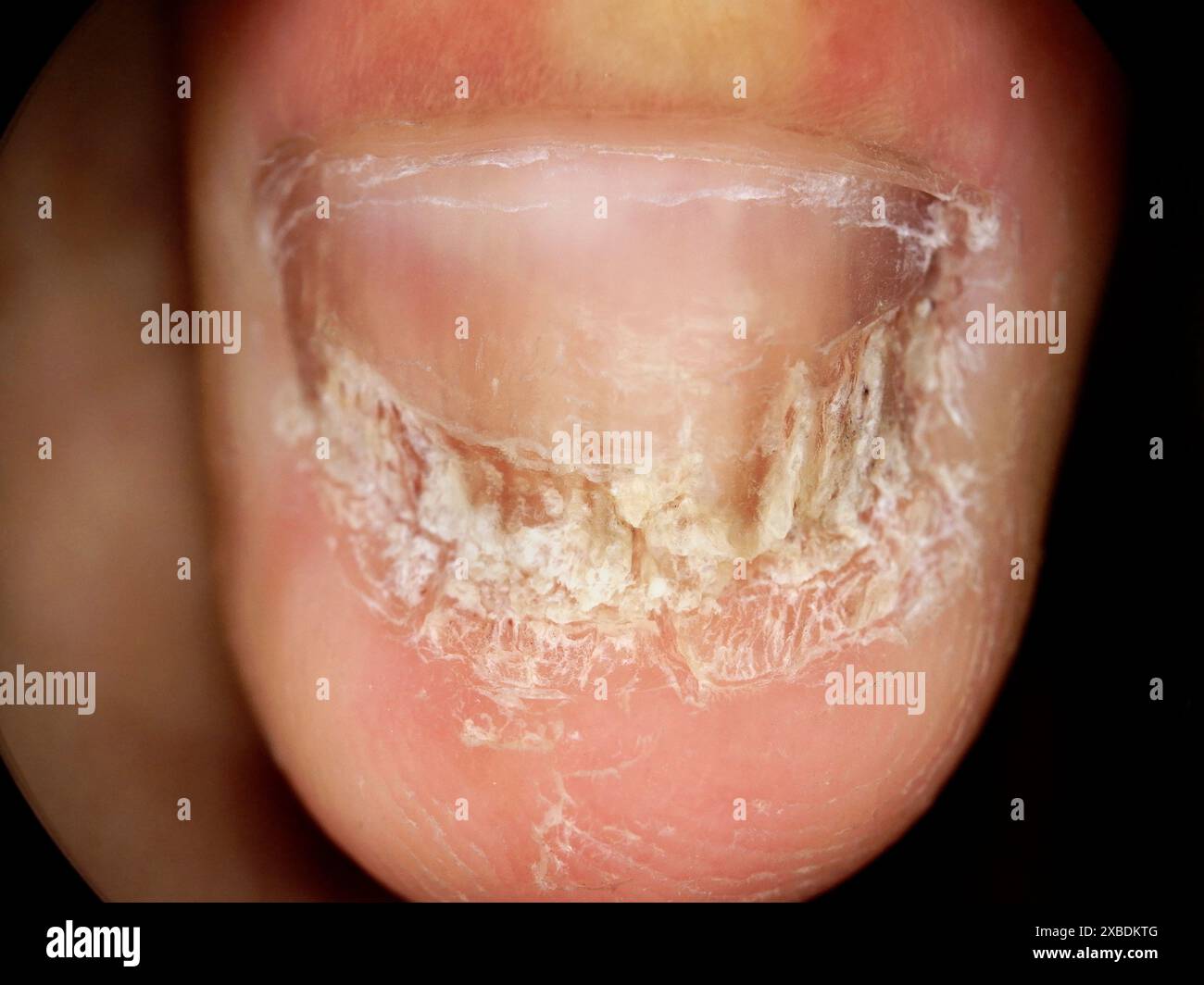 Dermatoscope image of the thumbnail of a patient with a ringworm ...