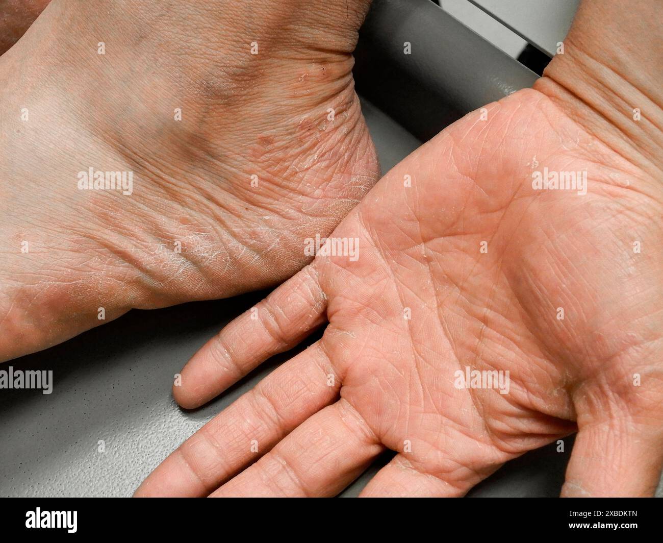 Ringworm infection on a patient's foot and hand. Ringworm is a disease ...