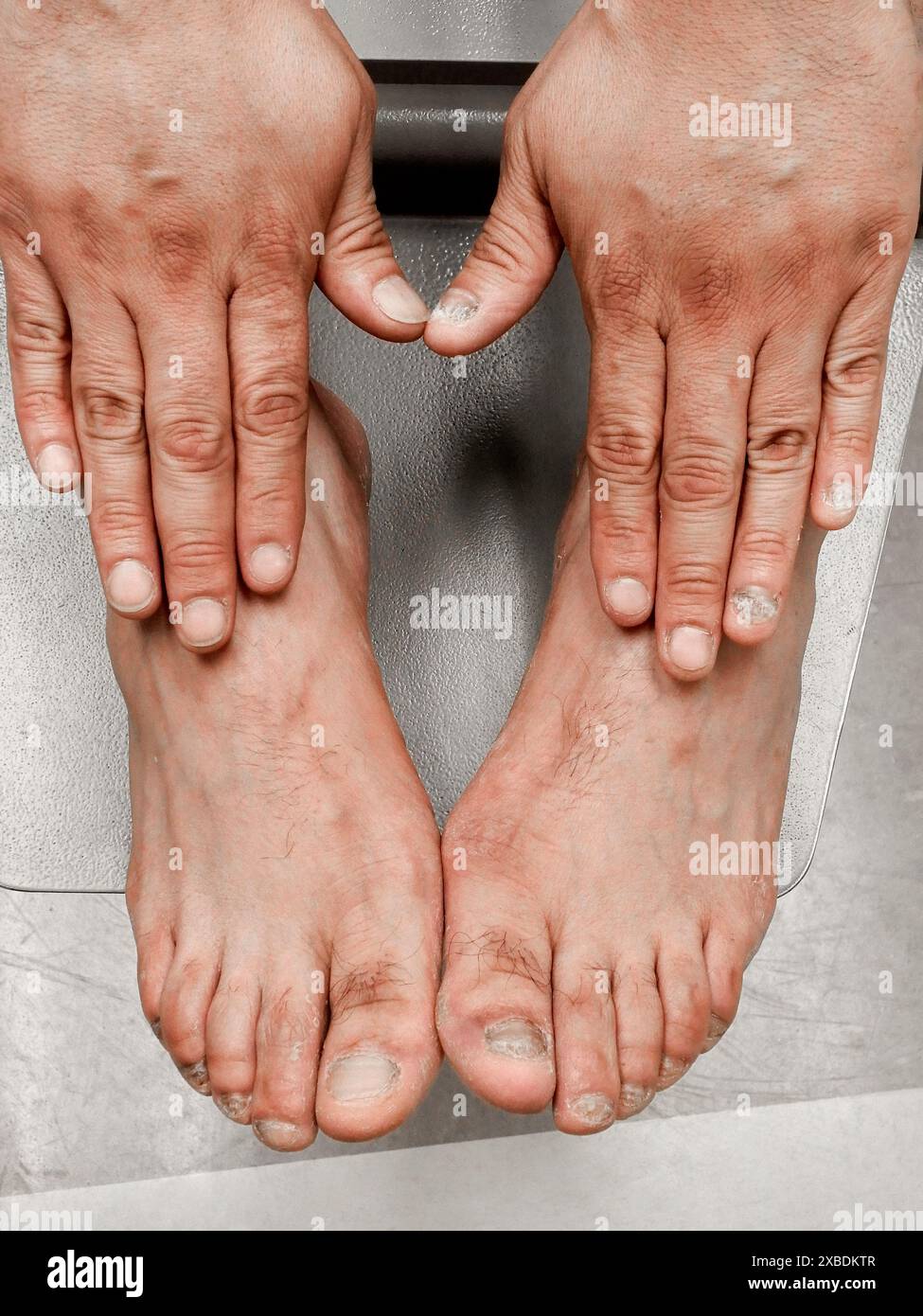 Ringworm infection on both of a patient's feet and one hand. Ringworm ...