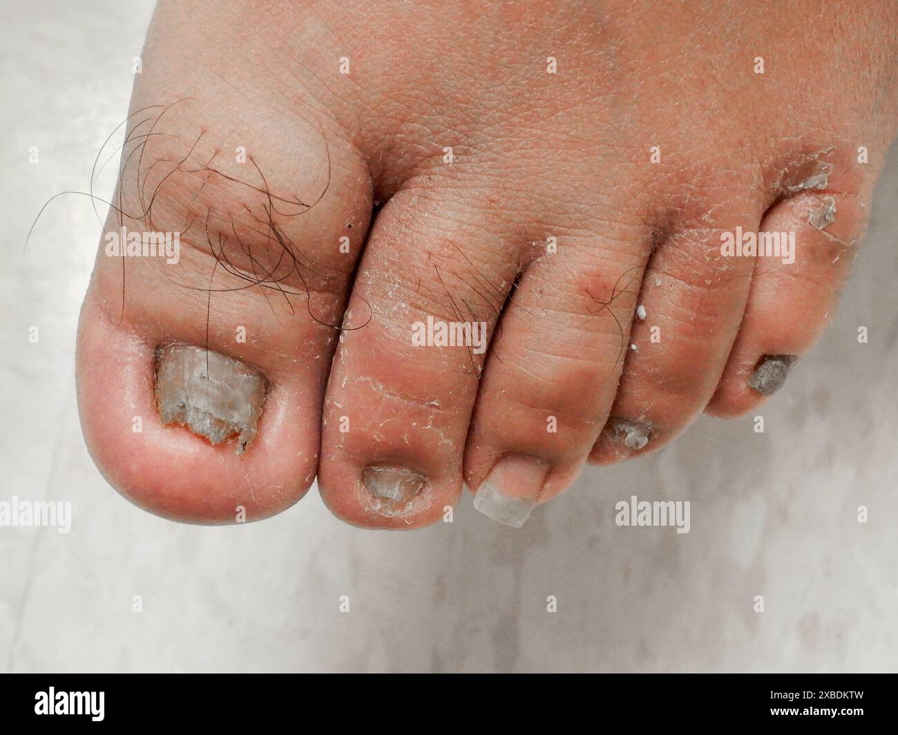 Toes of a 20 year old Hispanic male patient with Athlete's foot ...