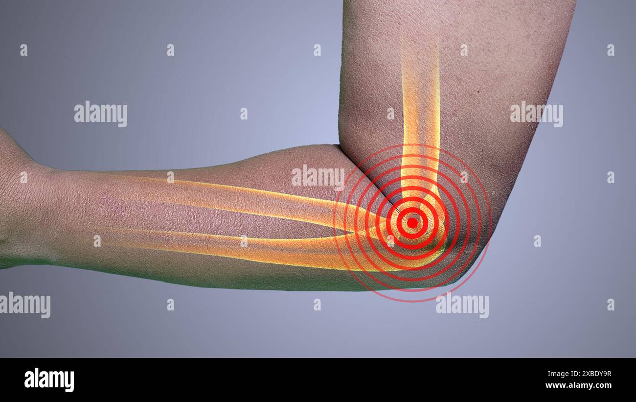Carpal tunnel syndrome hi-res stock photography and images - Alamy