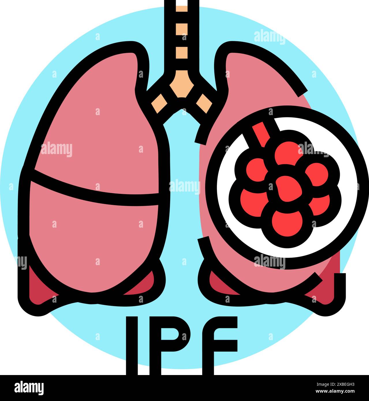 Pulmonary fibrosis Stock Vector Images - Alamy