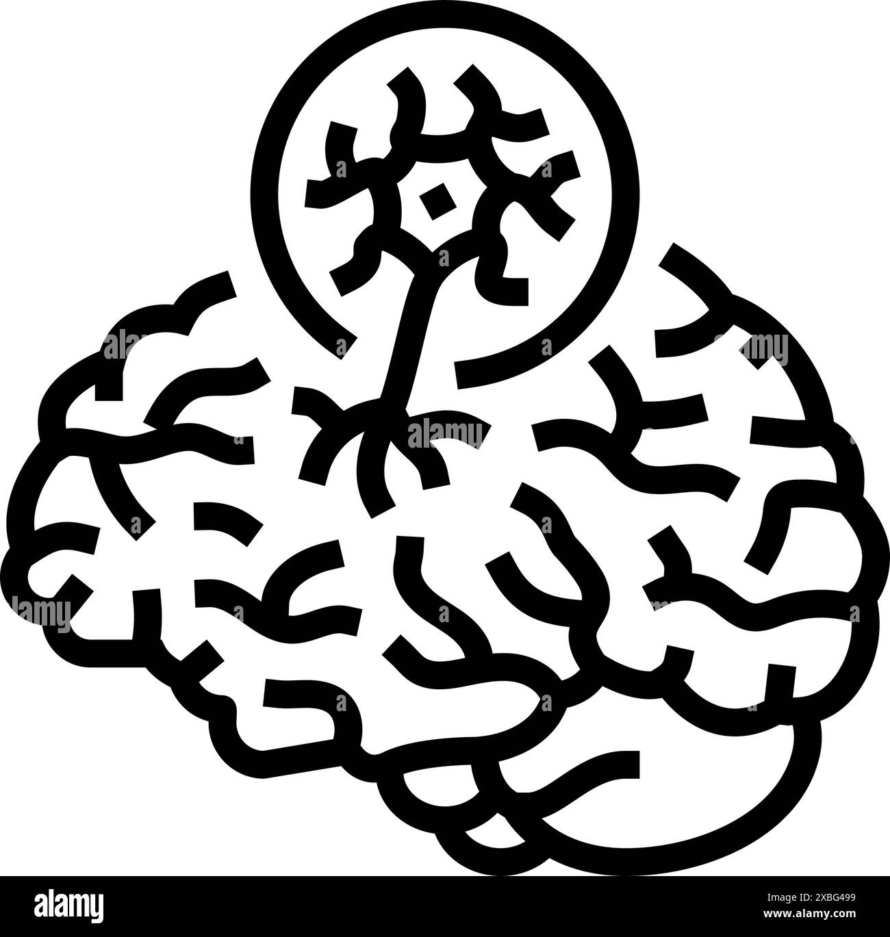 Tay sachs disease Black and White Stock Photos & Images - Alamy