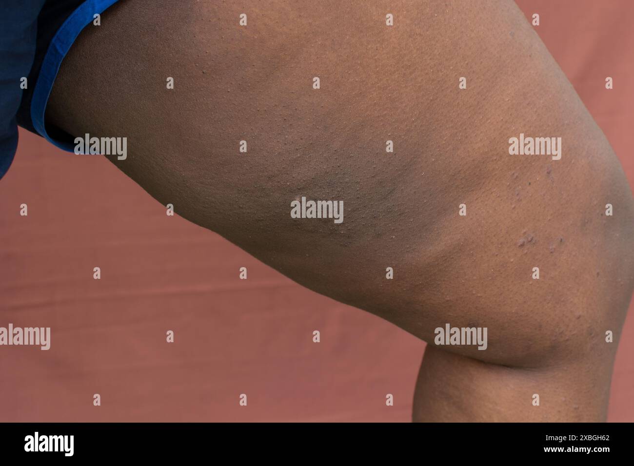 Dark inner thigh on brown skin, hyperpigmentation and darkening of ...