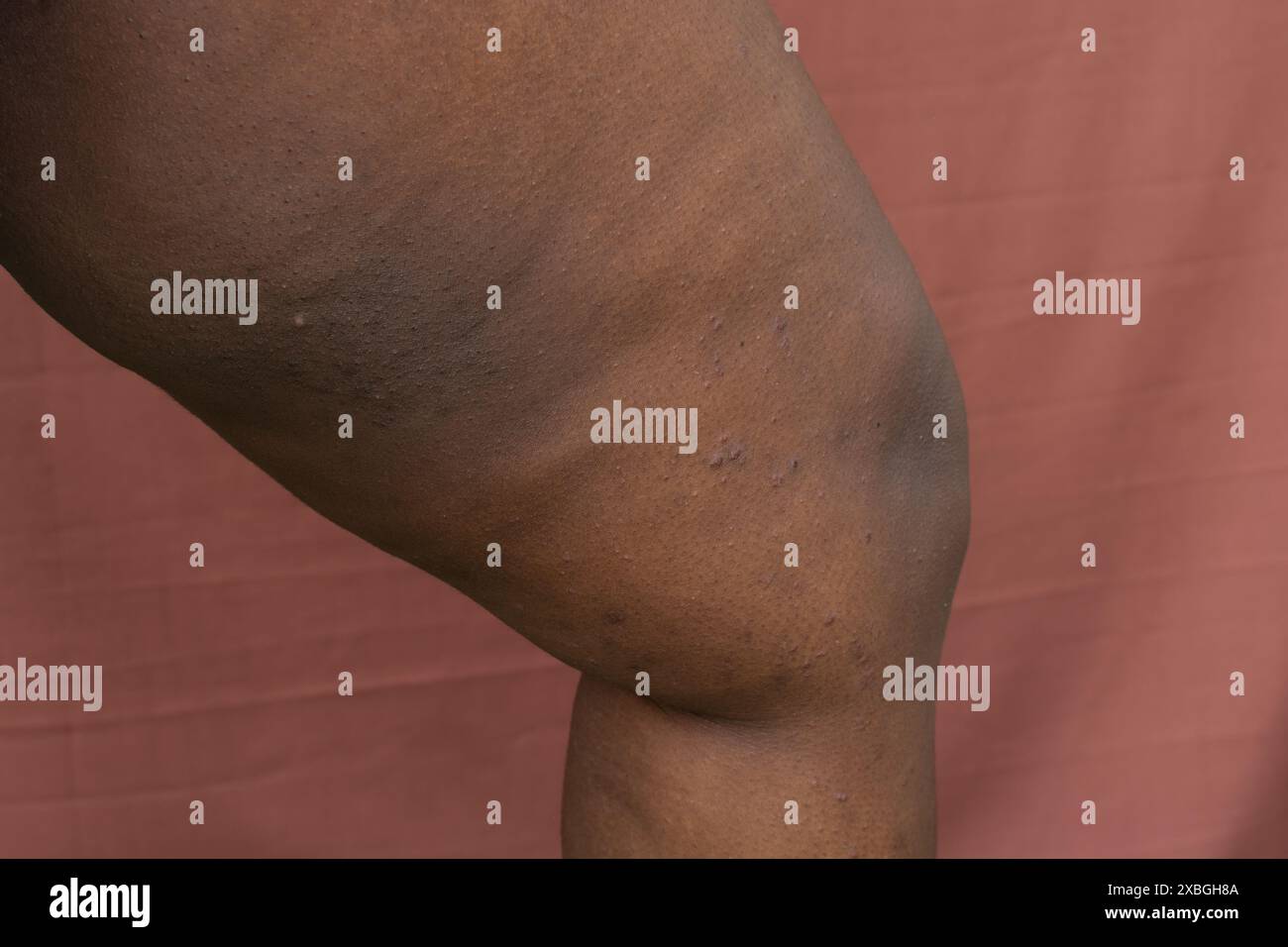 Dark inner thigh on brown skin, hyperpigmentation and darkening of ...