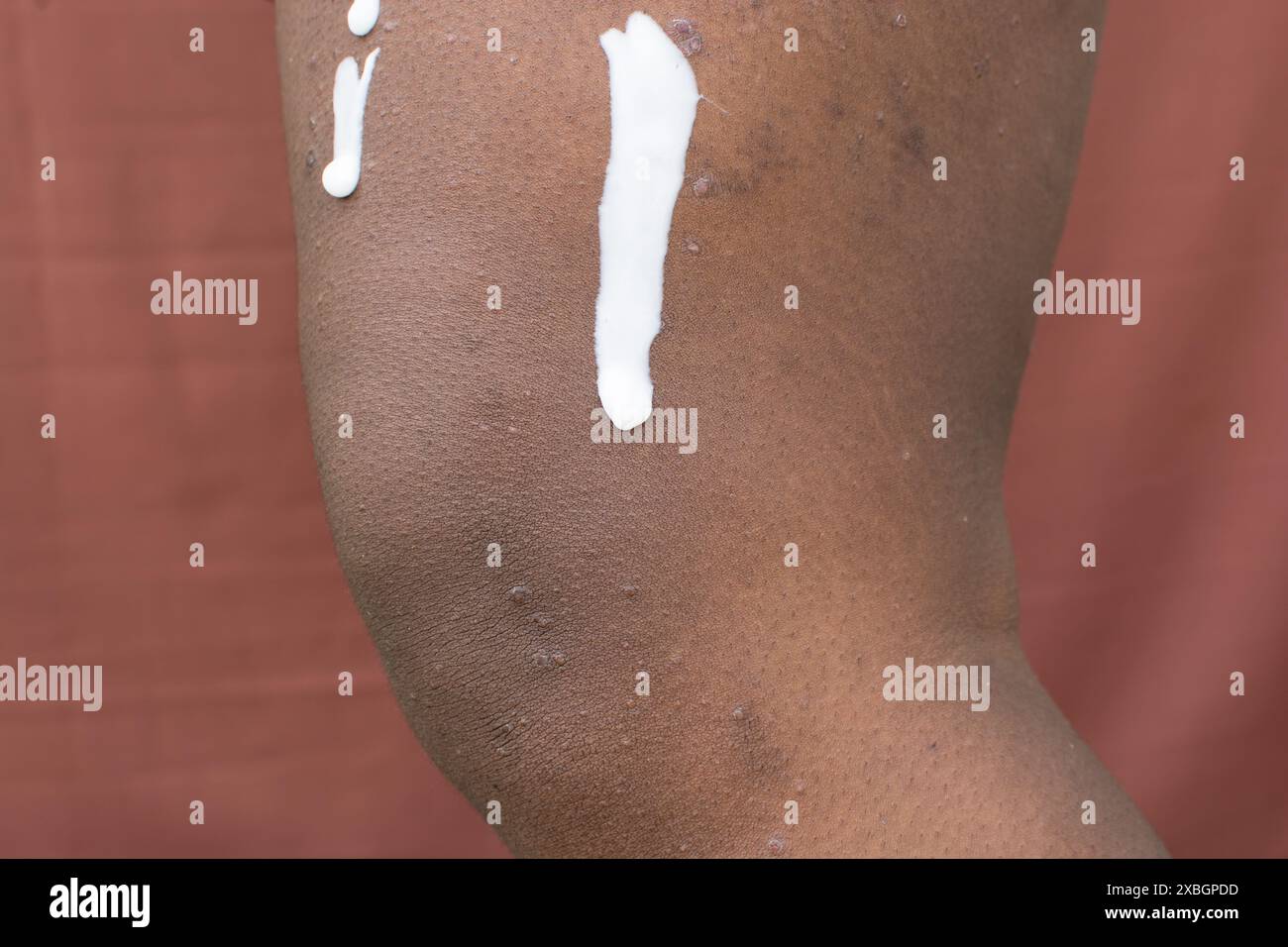 Lotion on brown skin with Eczema, Applying lotion on atopic dermatitis ...