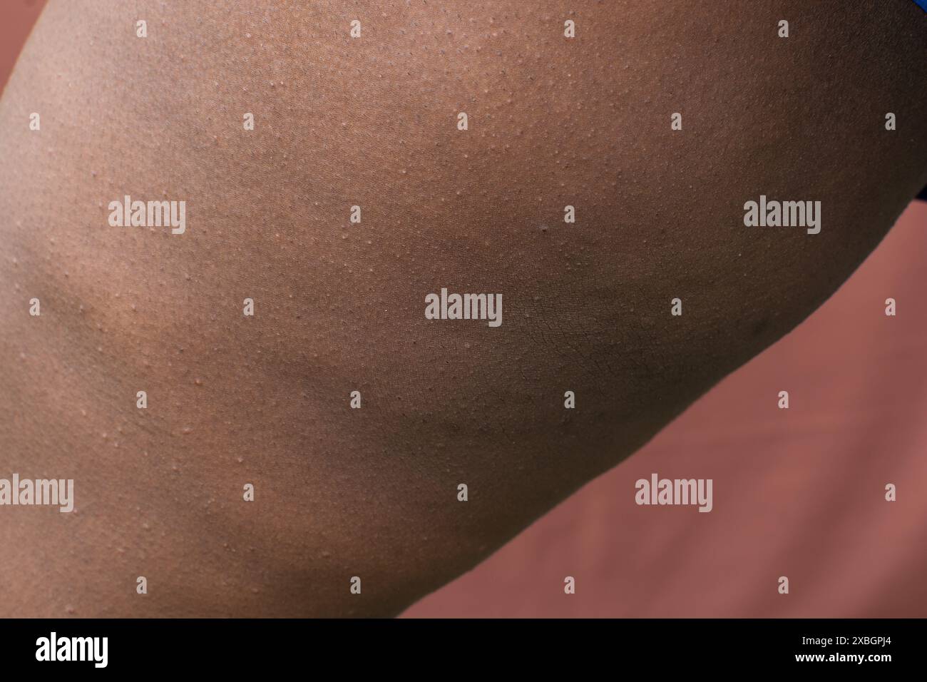 Dark inner thigh on brown skin, hyperpigmentation and darkening of ...