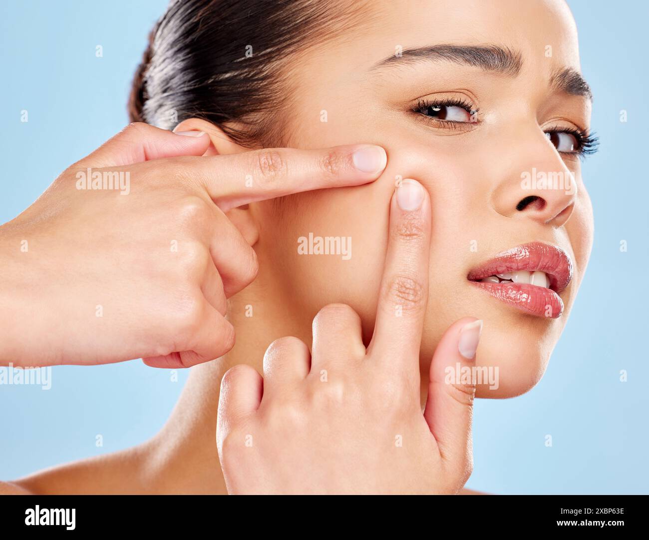 Sad girl pimple skin in hi-res stock photography and images - Alamy