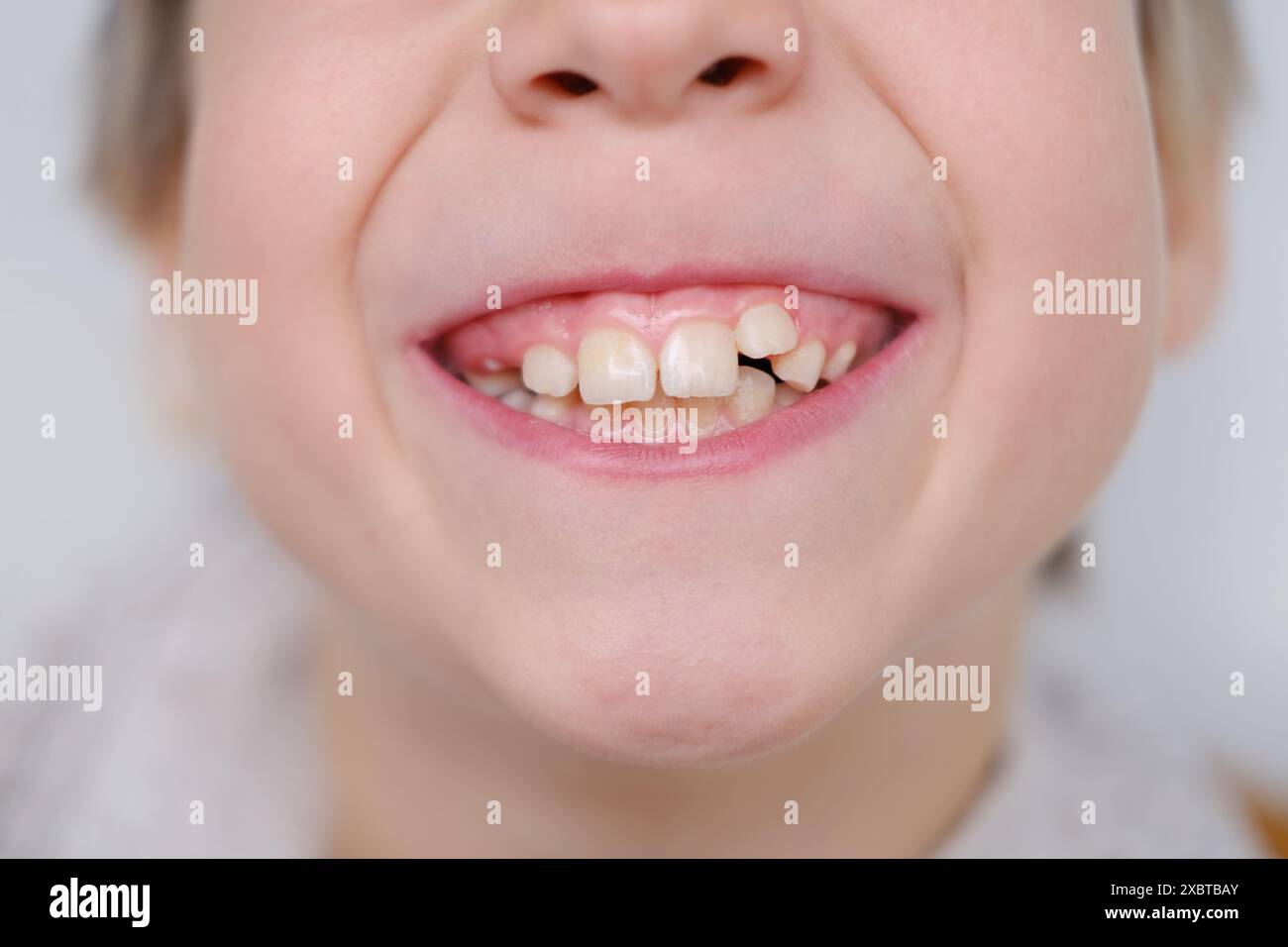 Young Smiling child, boy, age 10 reveals growing teeth, marking ...