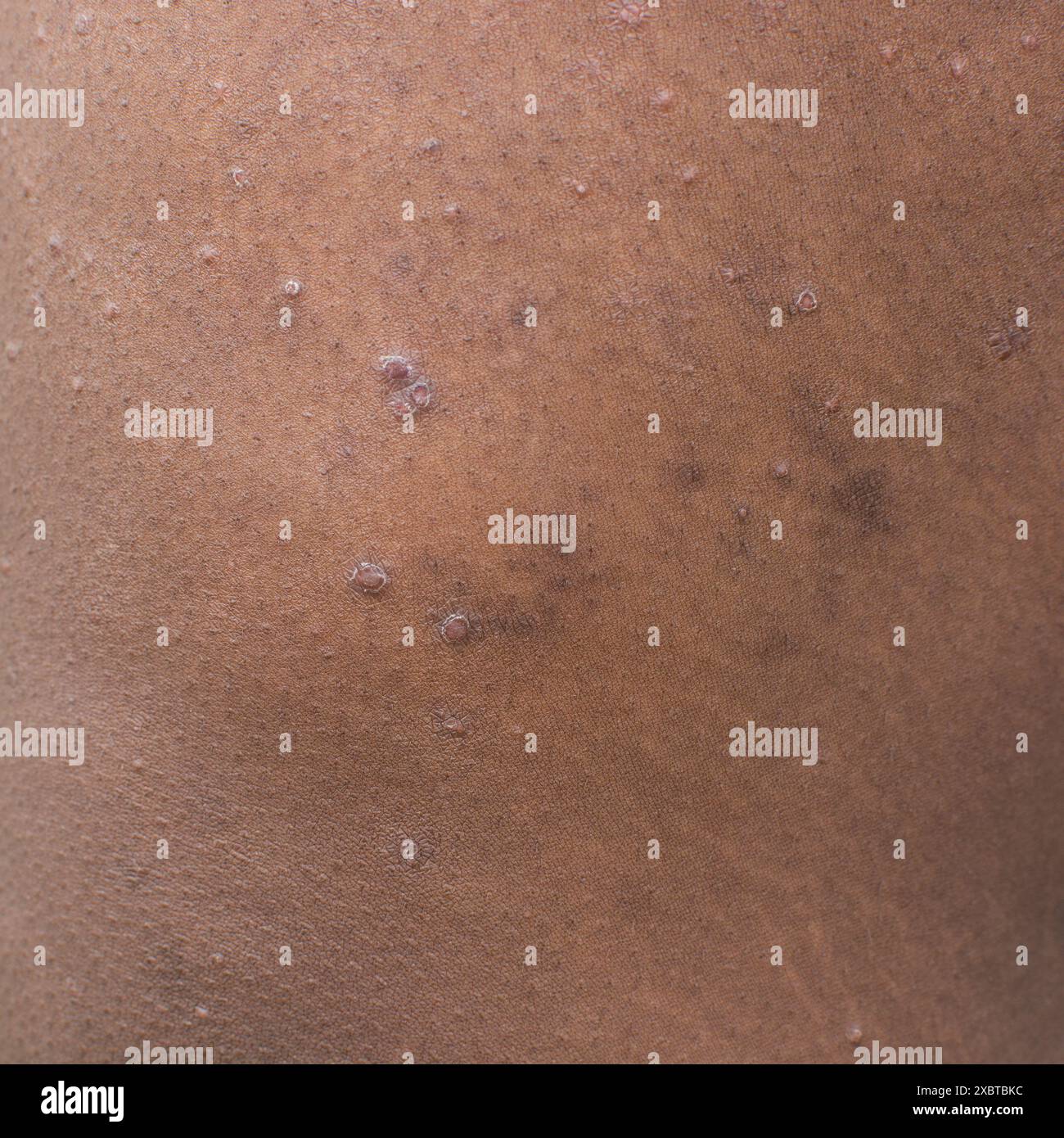 Eczema on brown skin, atopic dermatitis and prurigo nodularis on brown ...