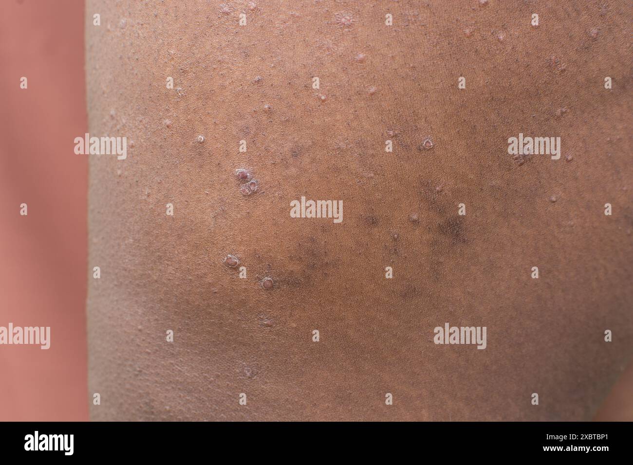 Eczema on brown skin, atopic dermatitis and prurigo nodularis on brown ...