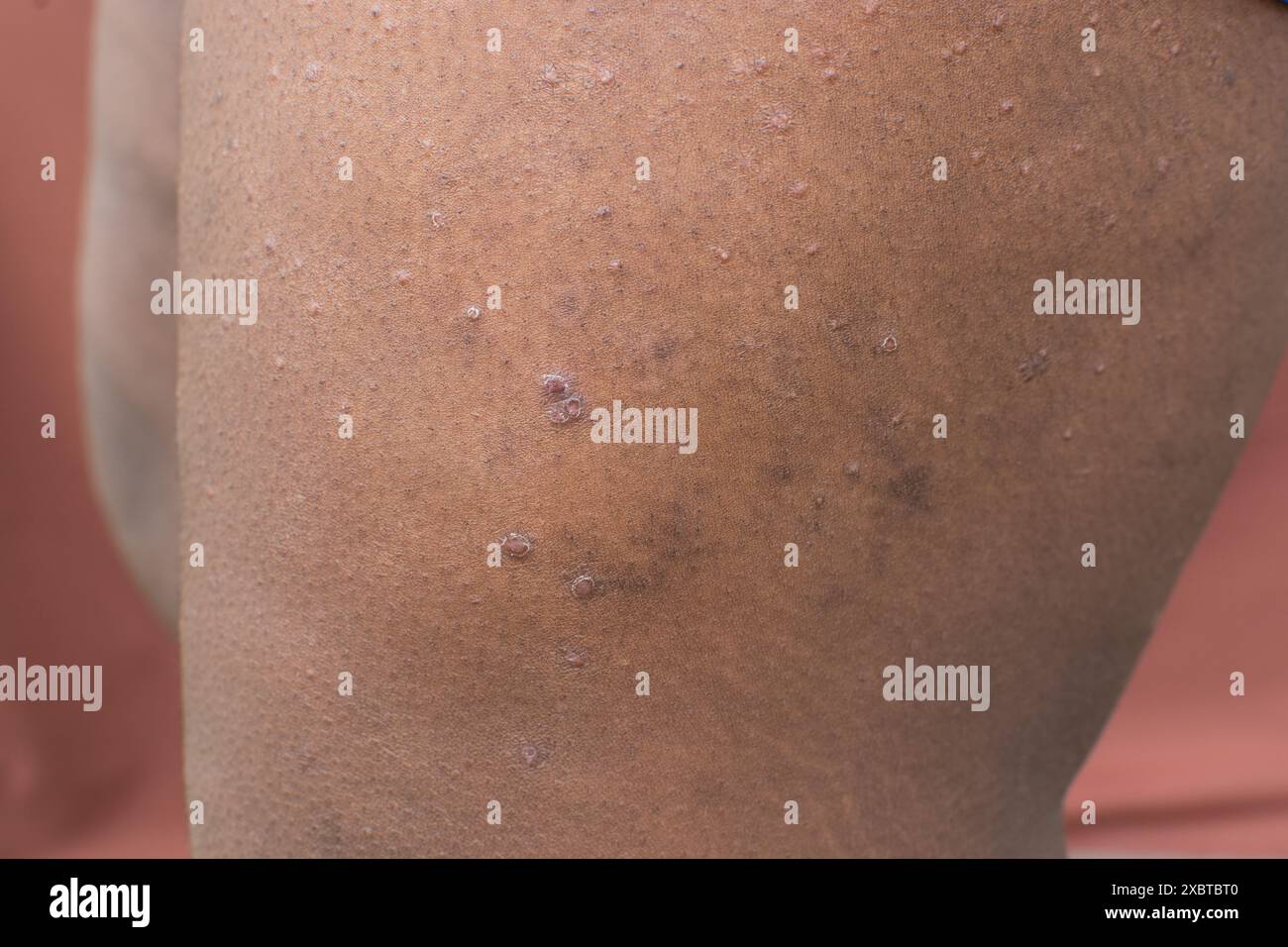 Eczema on brown skin, atopic dermatitis and prurigo nodularis on brown ...