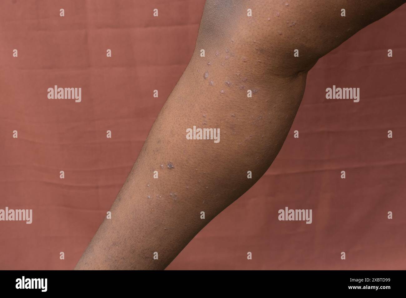 Eczema on brown skin, atopic dermatitis and prurigo nodularis on brown ...