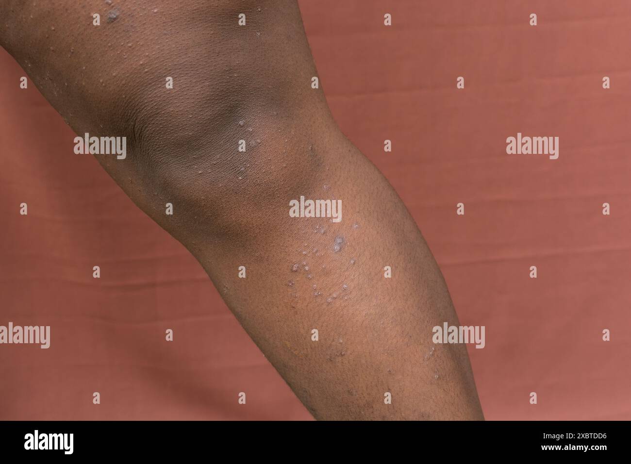 Eczema on brown skin, atopic dermatitis and prurigo nodularis on brown ...
