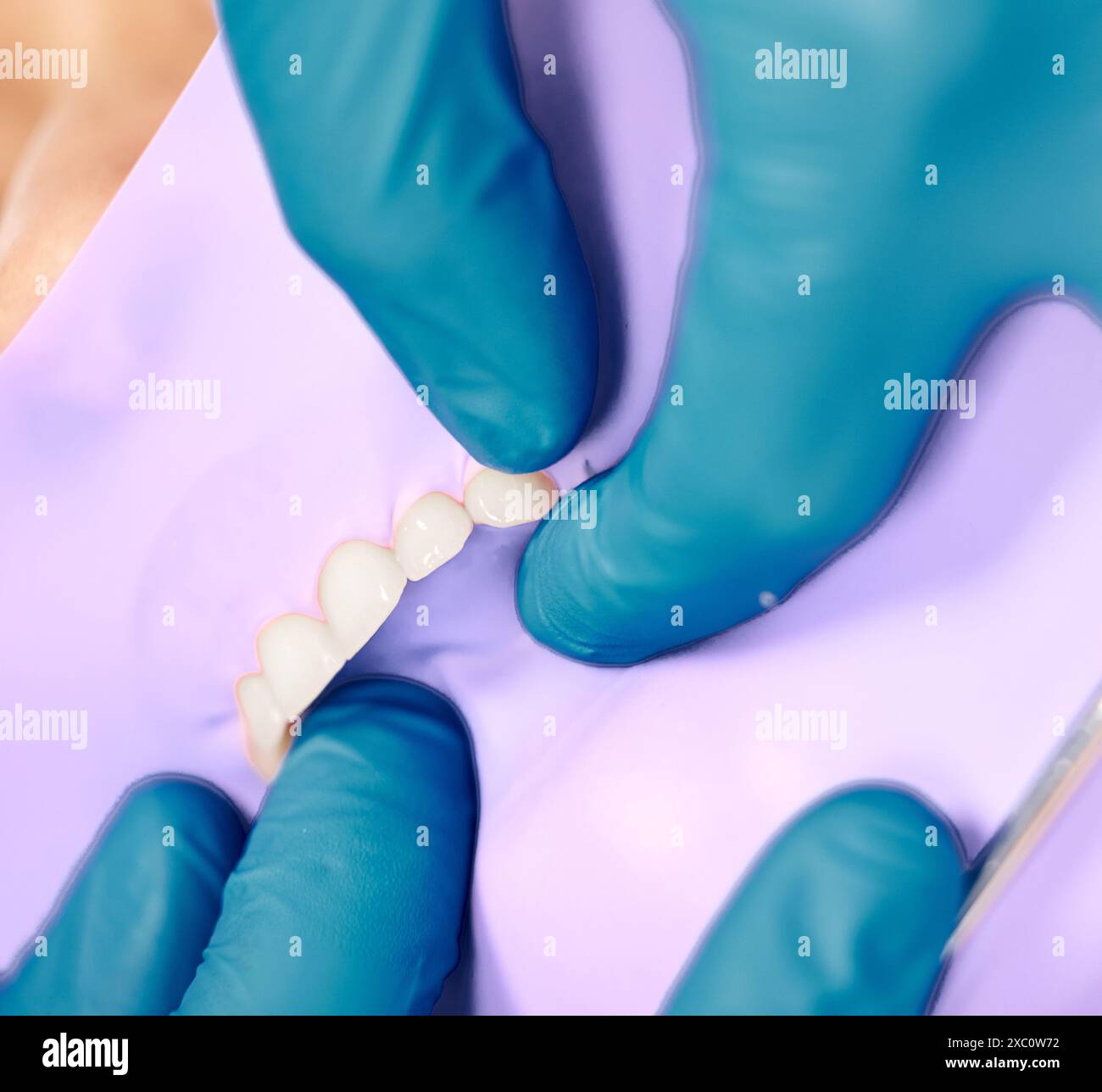 Dentist, hands and teeth for dental procedure with patients mouth ...