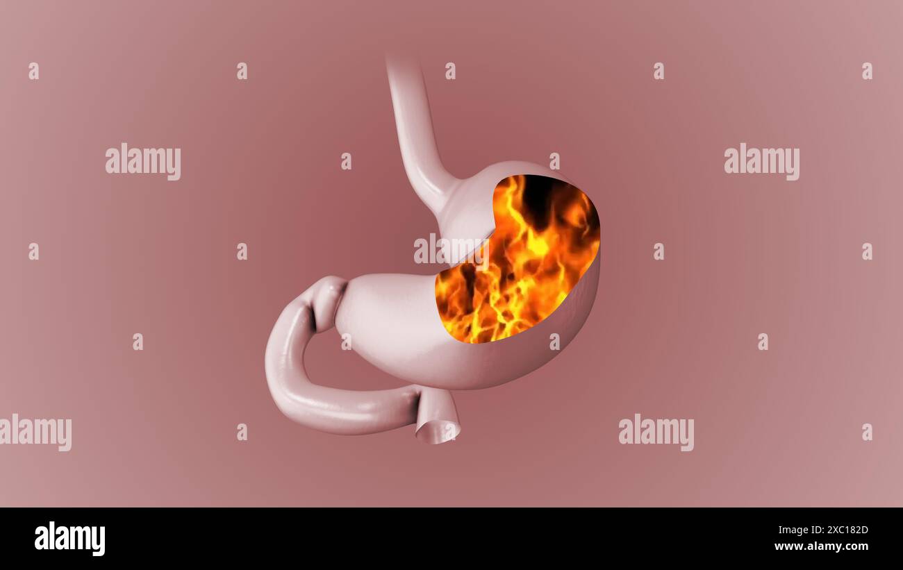 Stomach ulcer burning indigestion hi-res stock photography and images ...