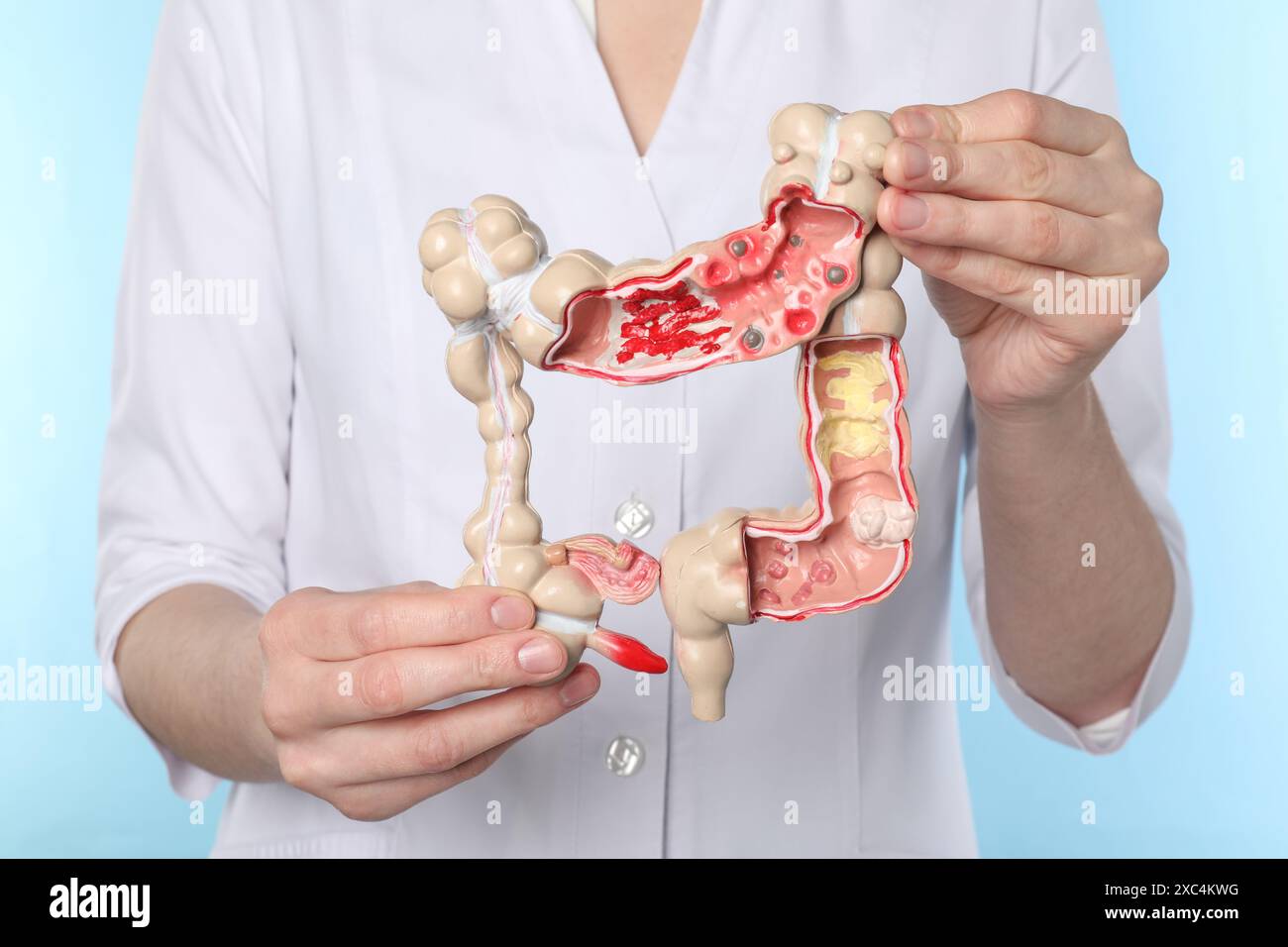 Doctor with model of large intestine on light blue background, closeup ...