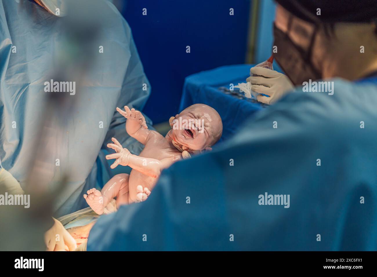 A baby is delivered during a caesarean section. The surgical procedure ...