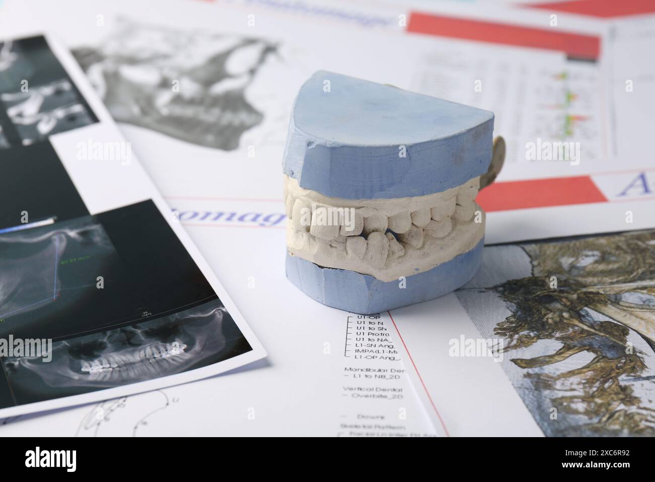 Dental model with gums, anatomy charts and panoramic x-ray. Cast of ...