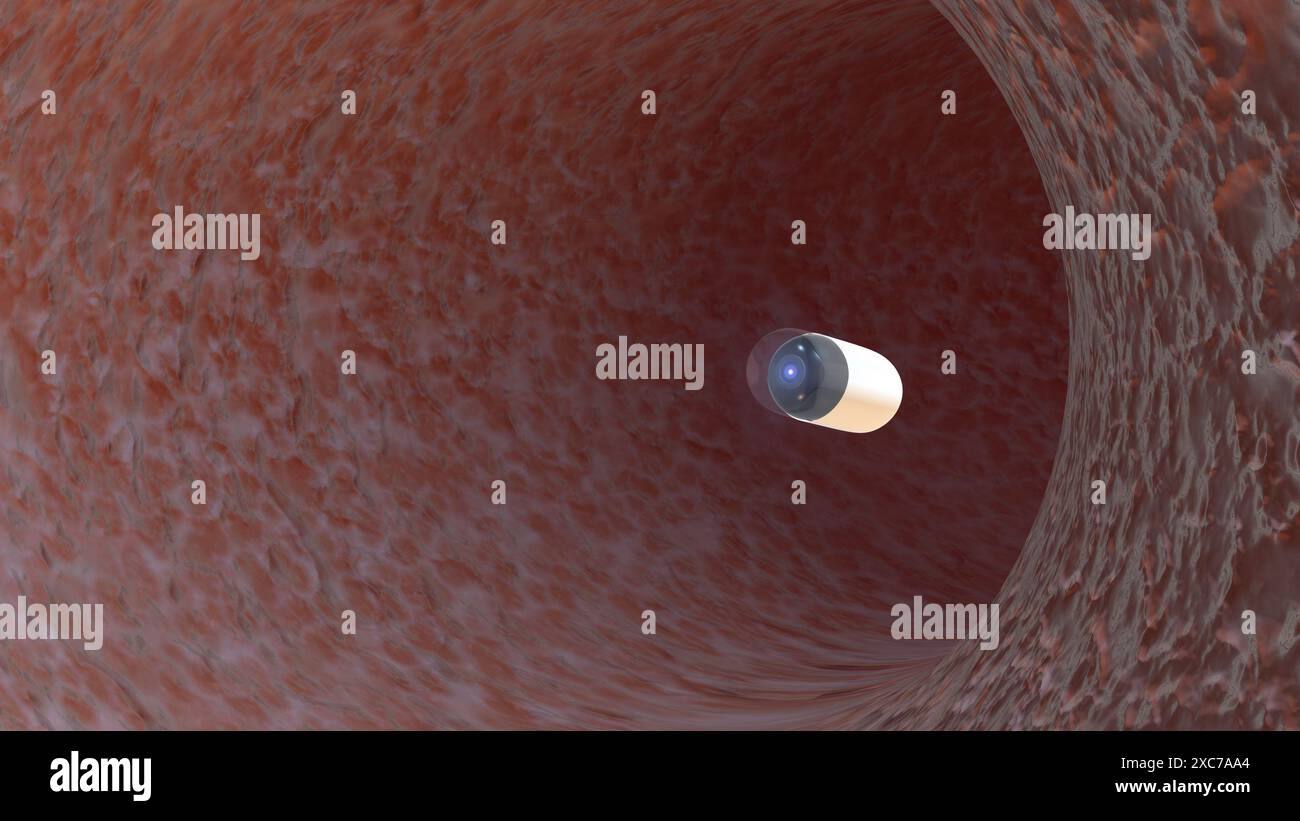 Endoscopy capsule hi-res stock photography and images - Alamy