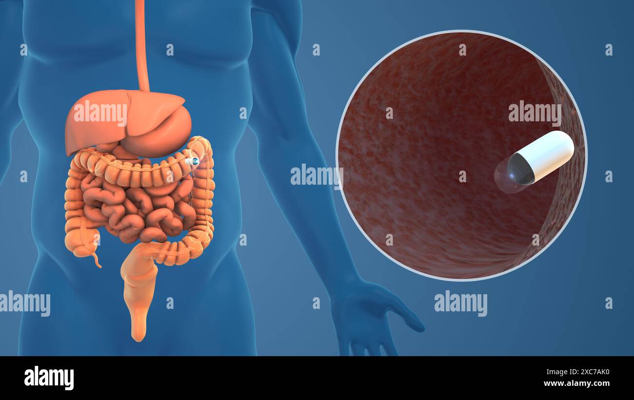 Endoscopy capsule hi-res stock photography and images - Alamy