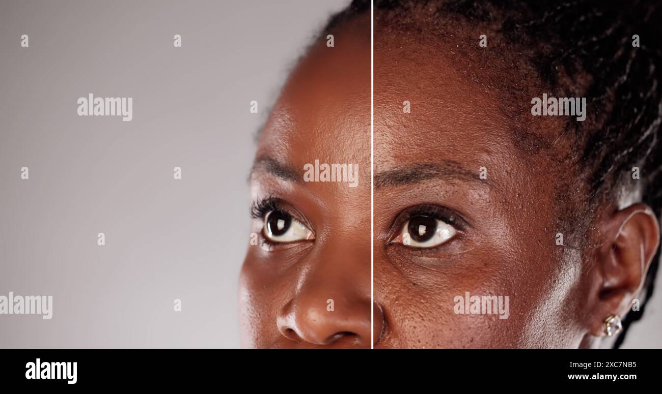 Forehead lift procedure hi-res stock photography and images - Alamy