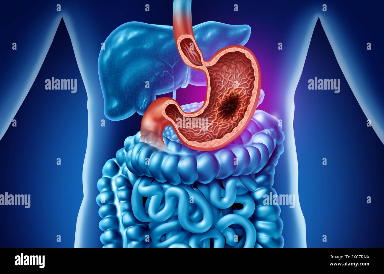 Gastric Cancer or stomach tumor in the digestive system as a medical ...