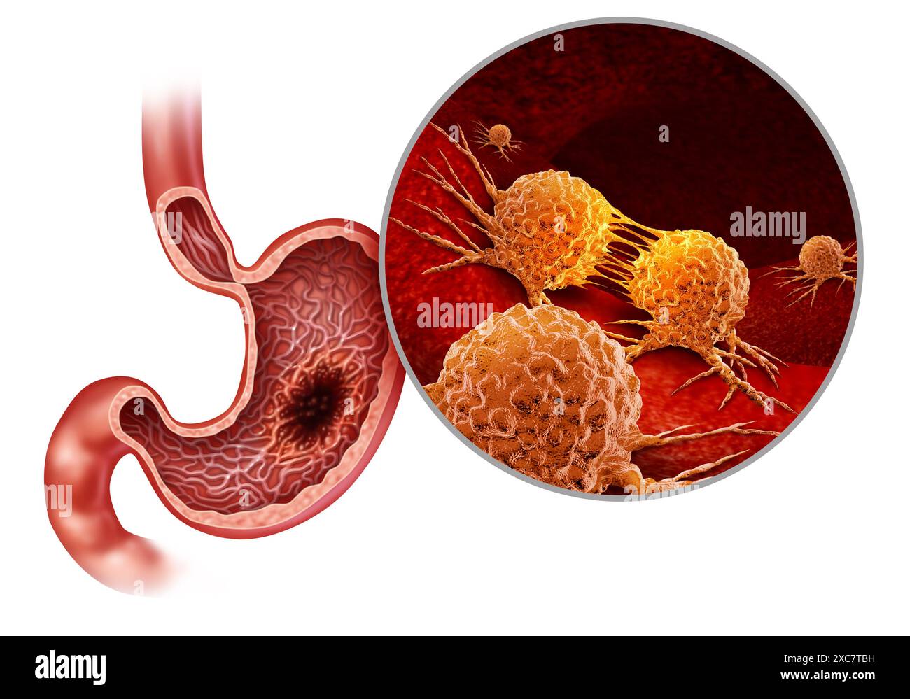 Human Stomach Cancer and Gastric tumor in the digestive system as a ...