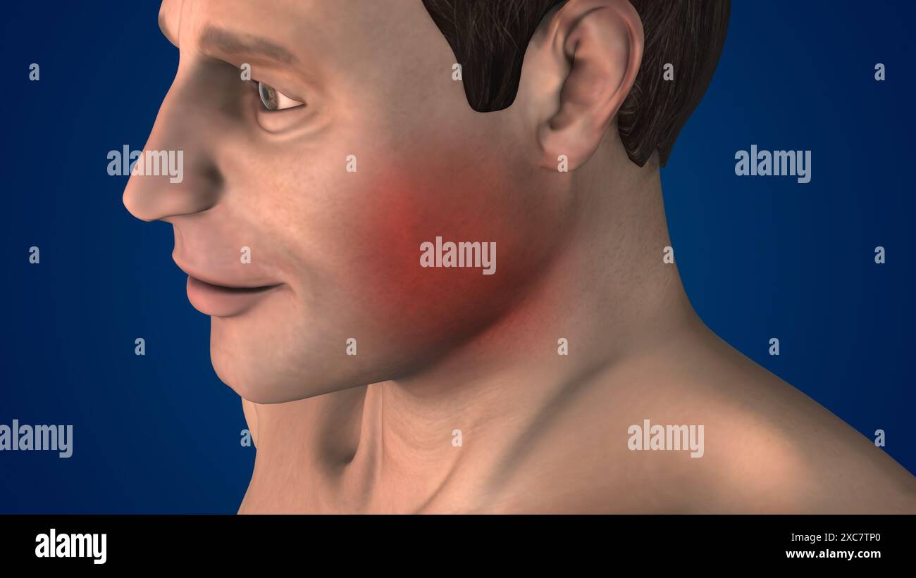 A jaw bone side view Fracture Stock Photo - Alamy