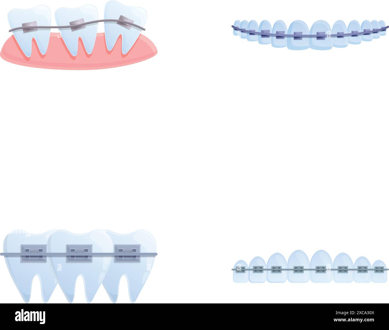 Brace system icons set cartoon vector. Orthodontic brace system on teeth. Orthodontic treatment ...