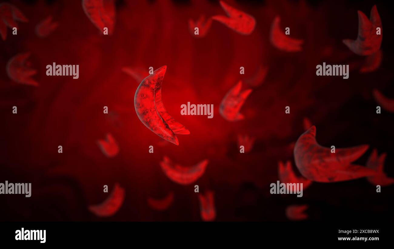 Sickle cell disease hi-res stock photography and images - Alamy Sickle cell disease hi-res stock photography and images - Alamy