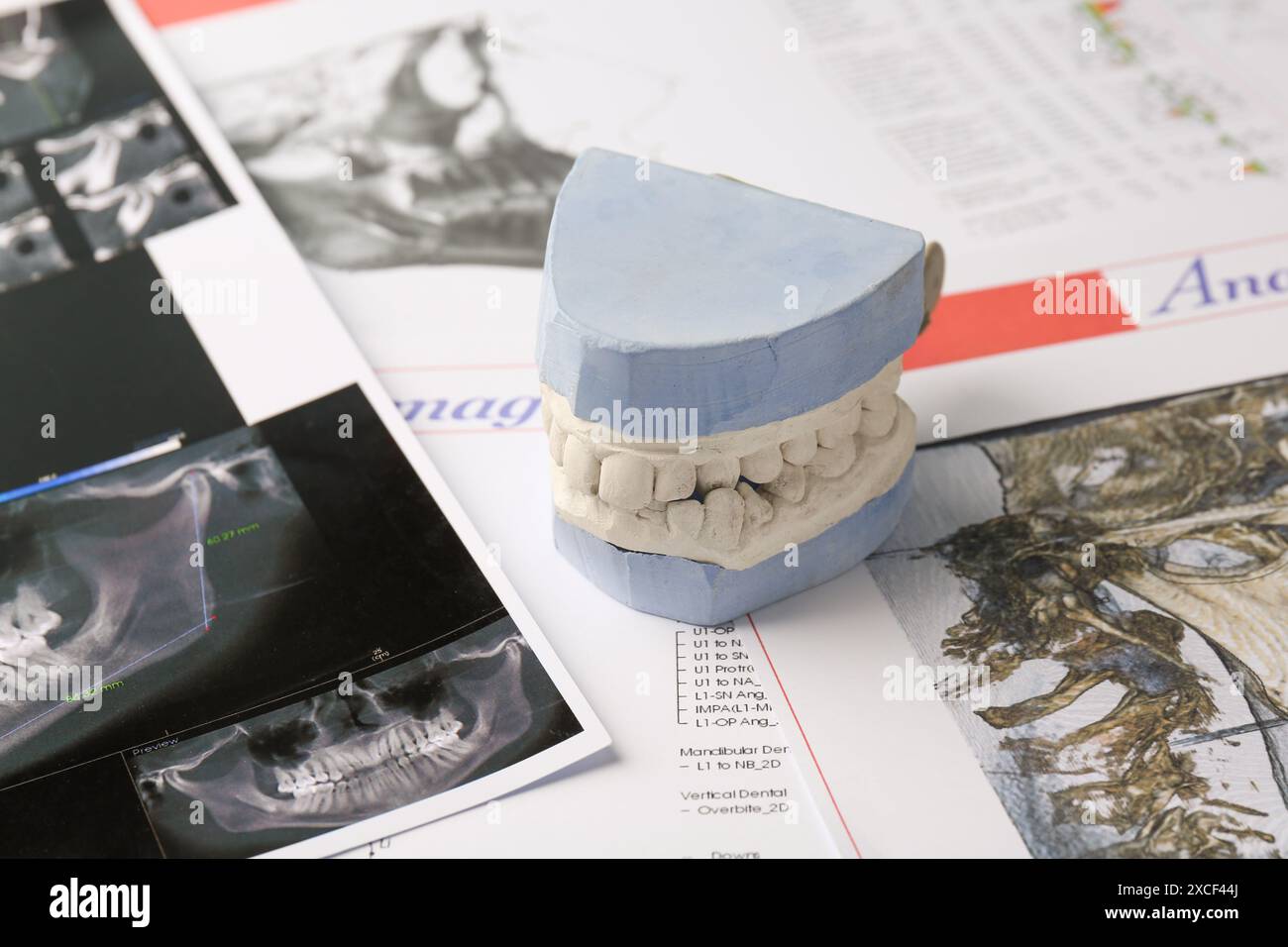 Dental model with gums, anatomy charts and panoramic x-ray. Cast of ...