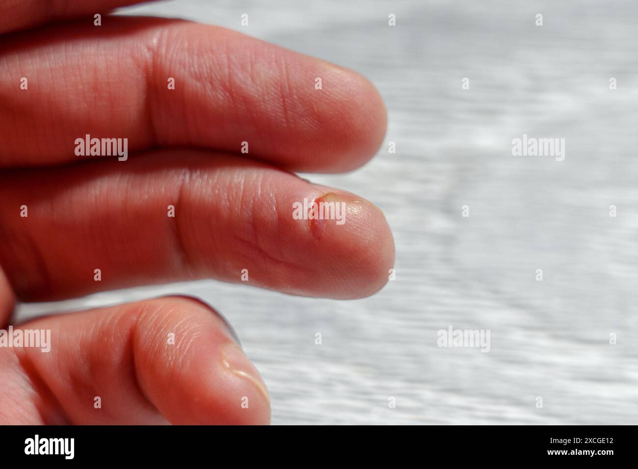 Painful cut hi-res stock photography and images - Alamy