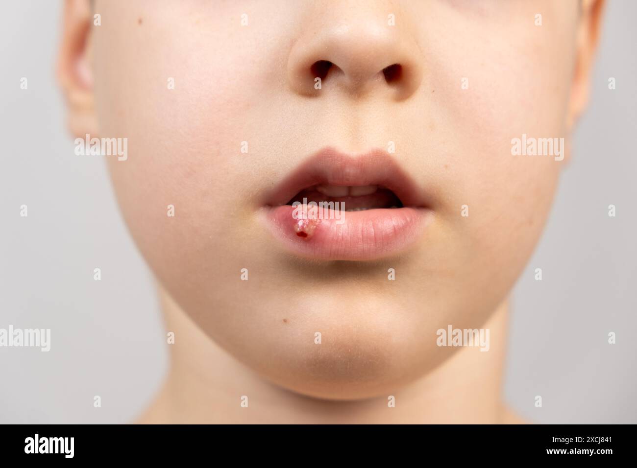 Skin damage, wound, abrasion on the lip of a small child Stock Photo ...
