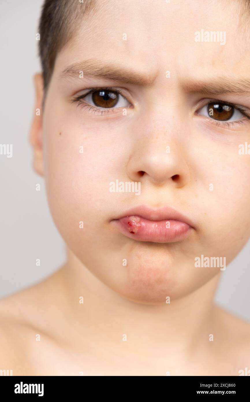 Portrait of a Serious Child with Injured Lip, Wound, Abrasion on Lip ...