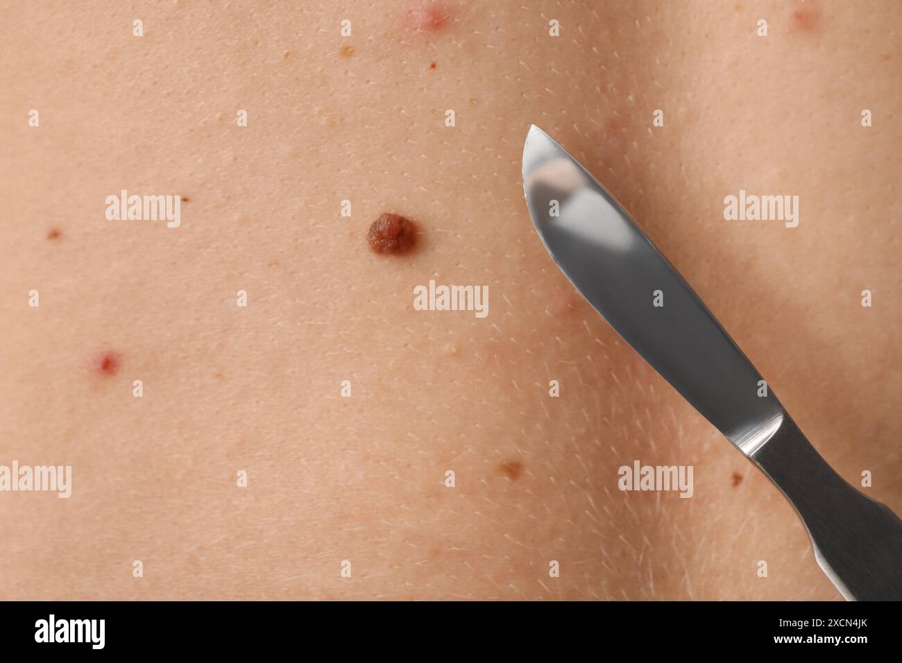 Moles on back skin cancer hi-res stock photography and images - Alamy
