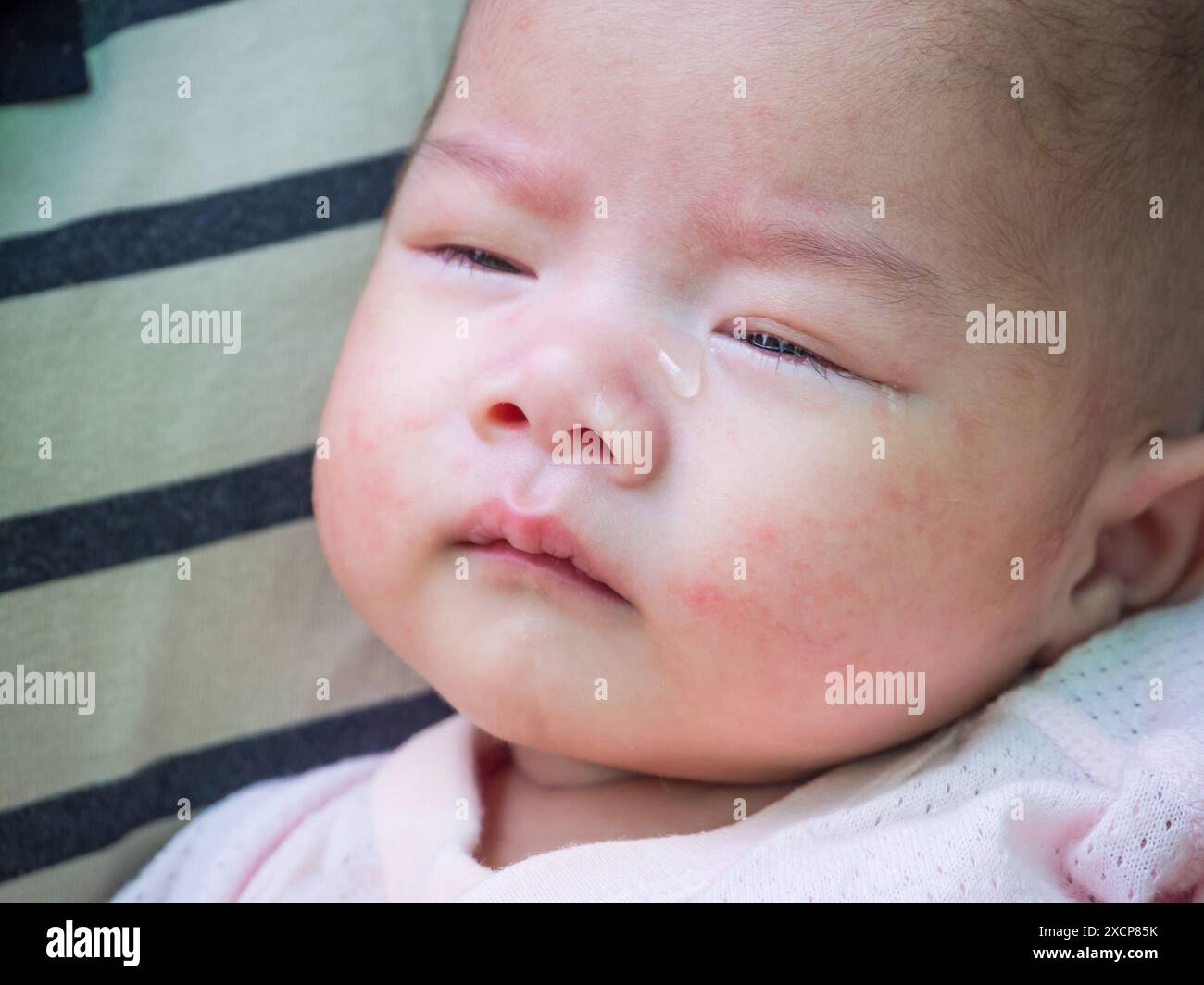 newborn baby with dermatitis allergy on face Stock Photo - Alamy