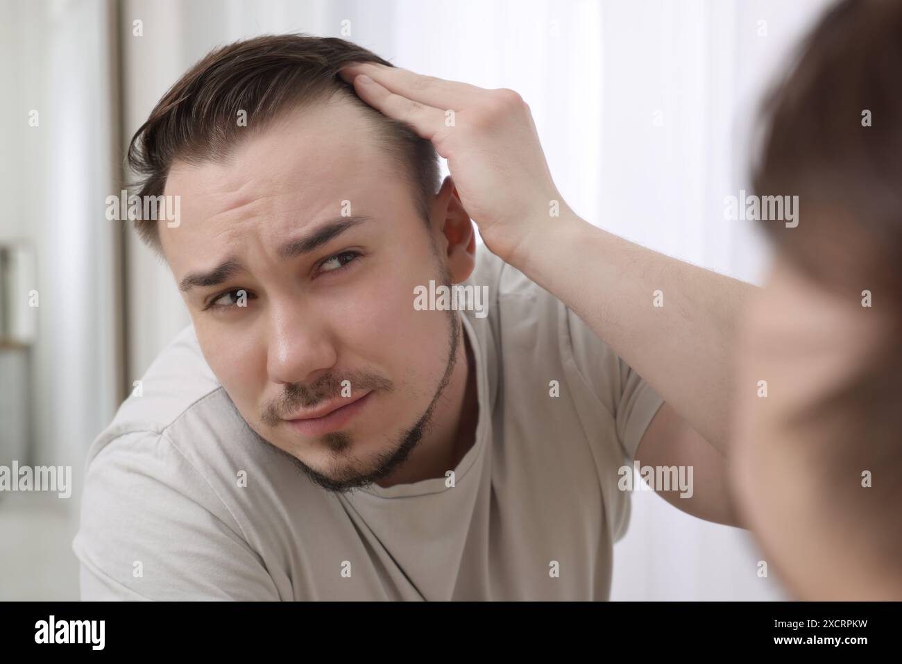 Baldness concept. Sad man with receding hairline looking at mirror ...