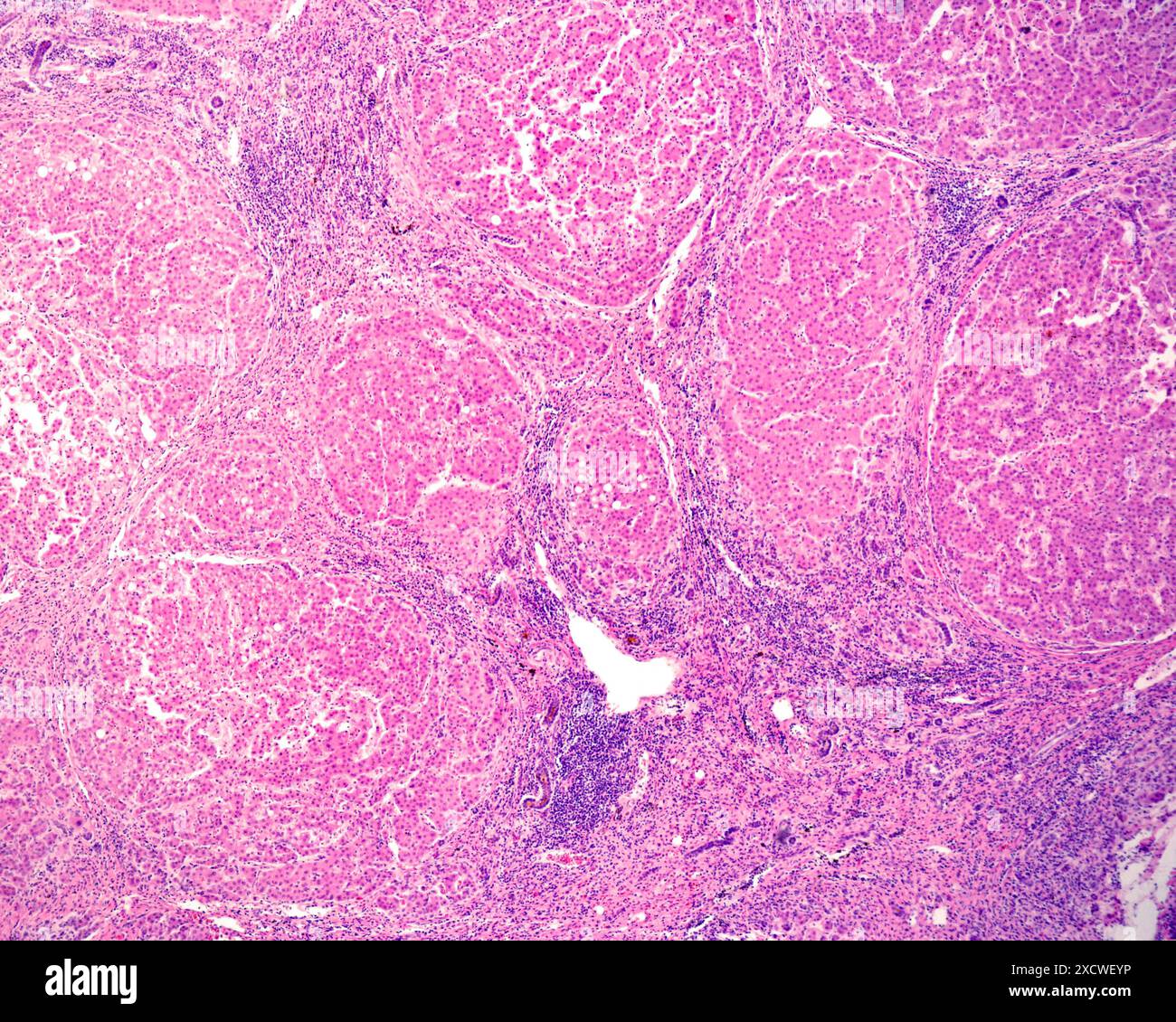 Light micrograph of a human liver affected by cirrhosis. There are ...