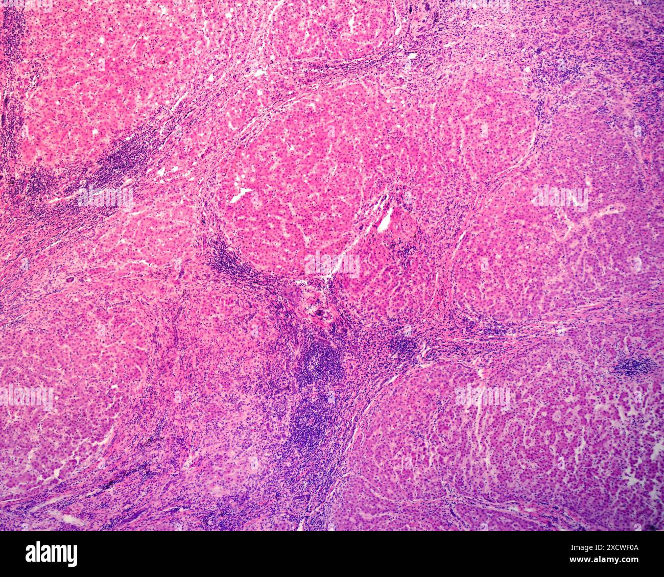 Light micrograph of a human liver affected by cirrhosis. There are ...