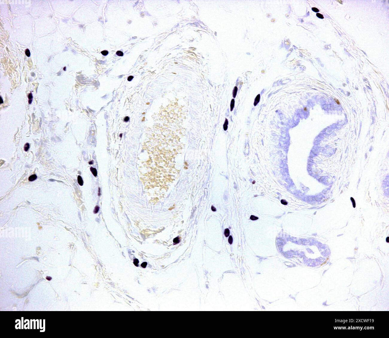 Mast cell, light micrograph. A mast cell, or mastocyte, is a connective ...