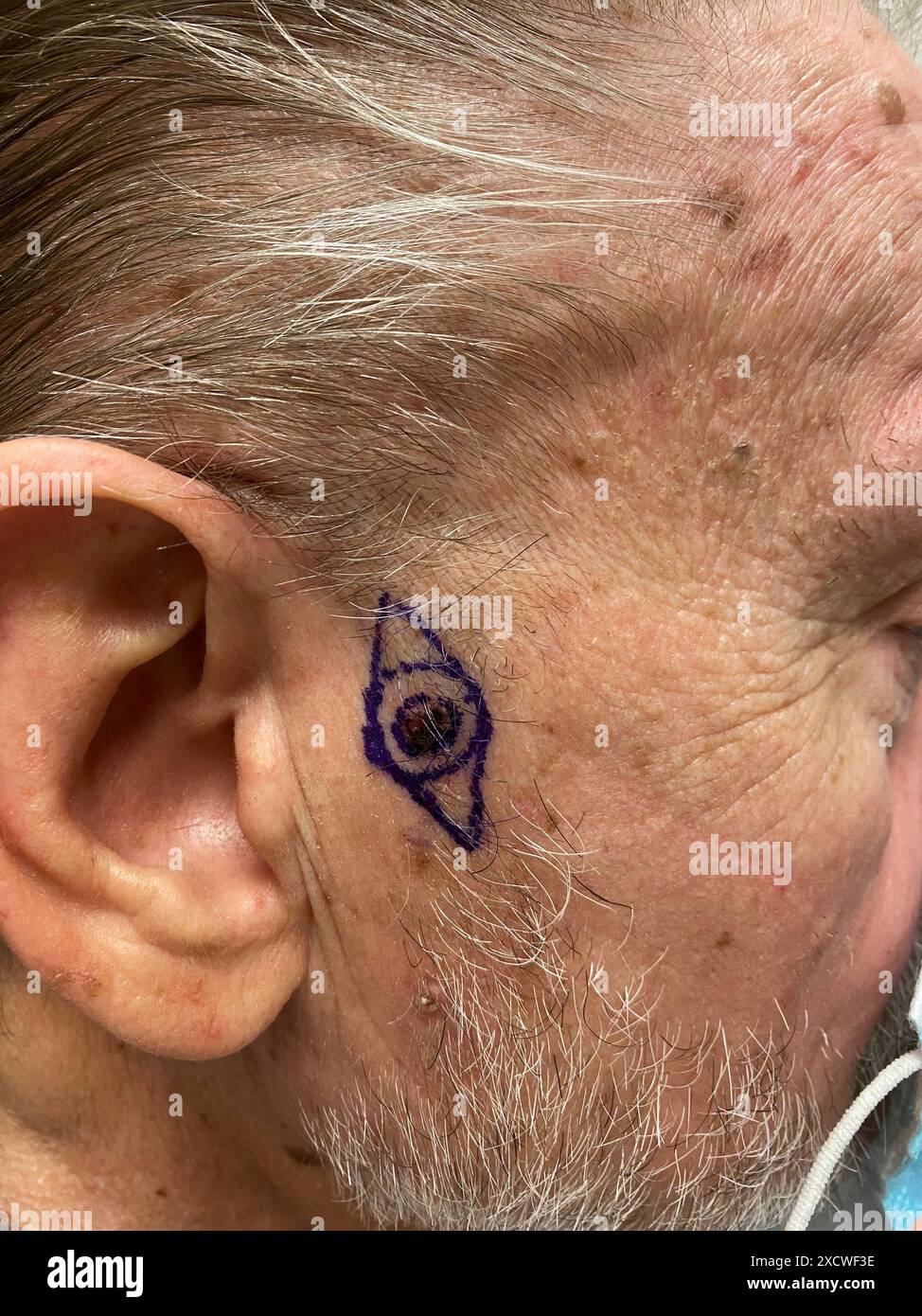 Basal cell carcinoma on a patient's face marked for elliptical excision ...