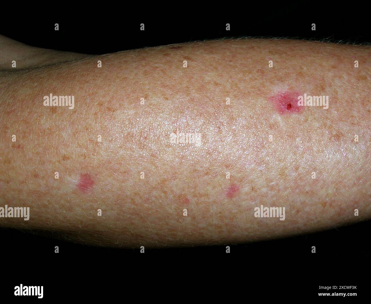 Three superficial basal cell carcinomas on the right forearm of a 41 ...
