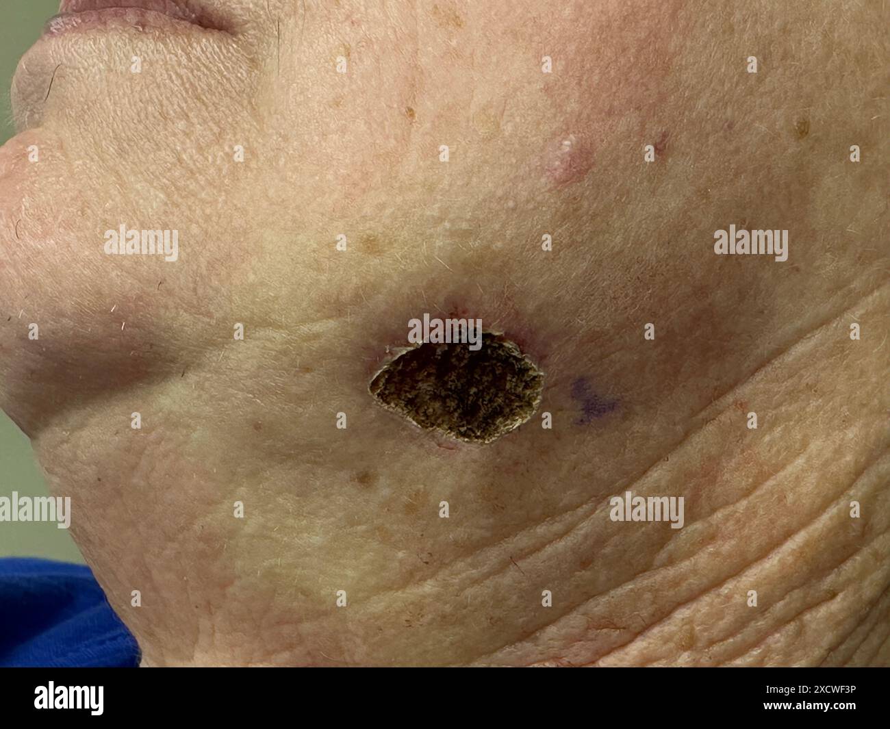 Editorial use only Lesion on the neck of a female patient where a ...