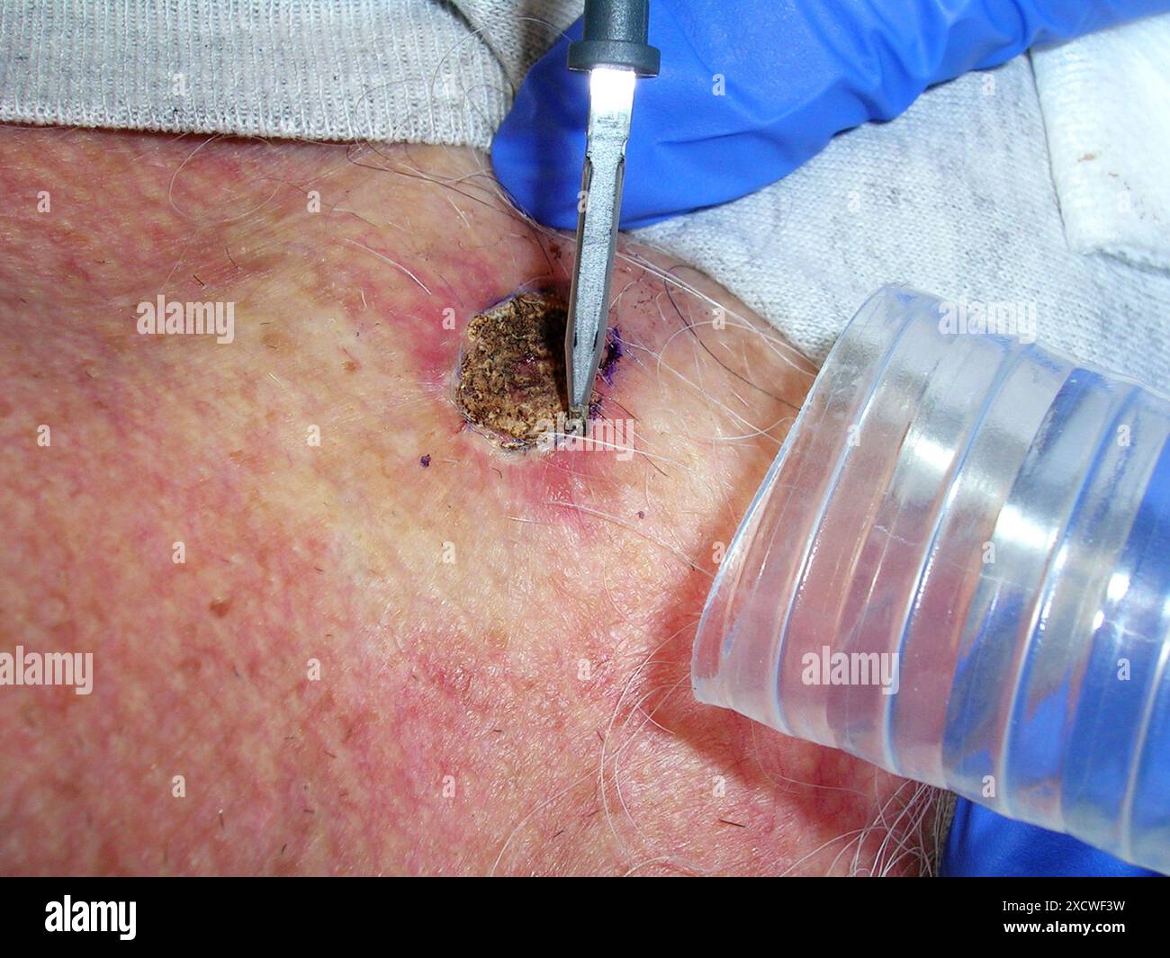 Superficial basal cell carcinoma on a patient's chest being removed by ...